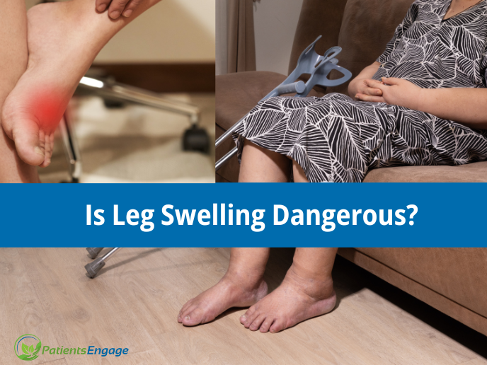 Leg Swelling: When To See A Doctor | Is Leg Swelling Dangerous ...