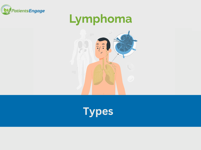 Types of Lymphoma and stages | Different Types of Lymphoma
