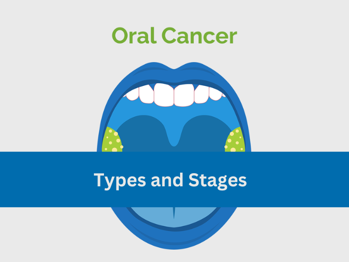 Stages of Oral Cancer | TNM Staging of oral cancer