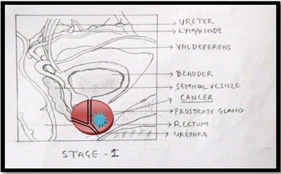 Prostate Cancer Stages | Stages of Prostate Cancer | PatientsEngage
