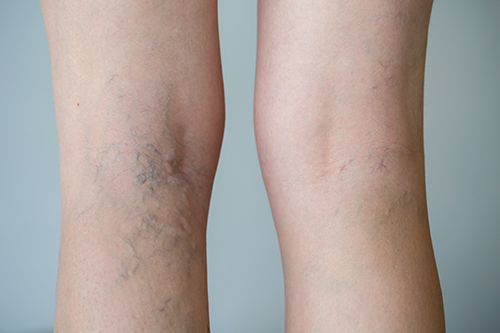 Managing Varicose Veins| How to manage swollen feet | PatientsEngage