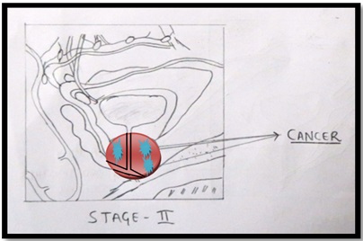 Prostate Cancer Stages | Stages of Prostate Cancer | PatientsEngage