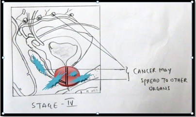 Prostate Cancer Stages | Stages of Prostate Cancer | PatientsEngage